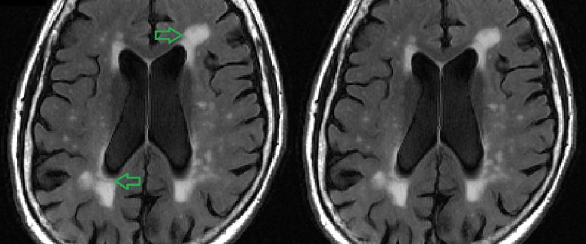 Can MRI show an old brain injury?